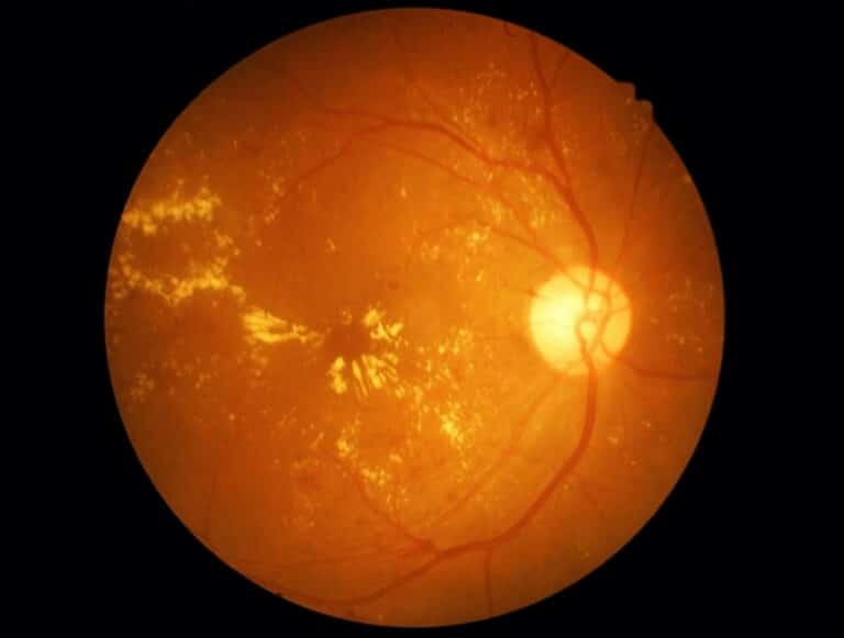 Diabetic Retinopathy - Alaska Retinal Consultants