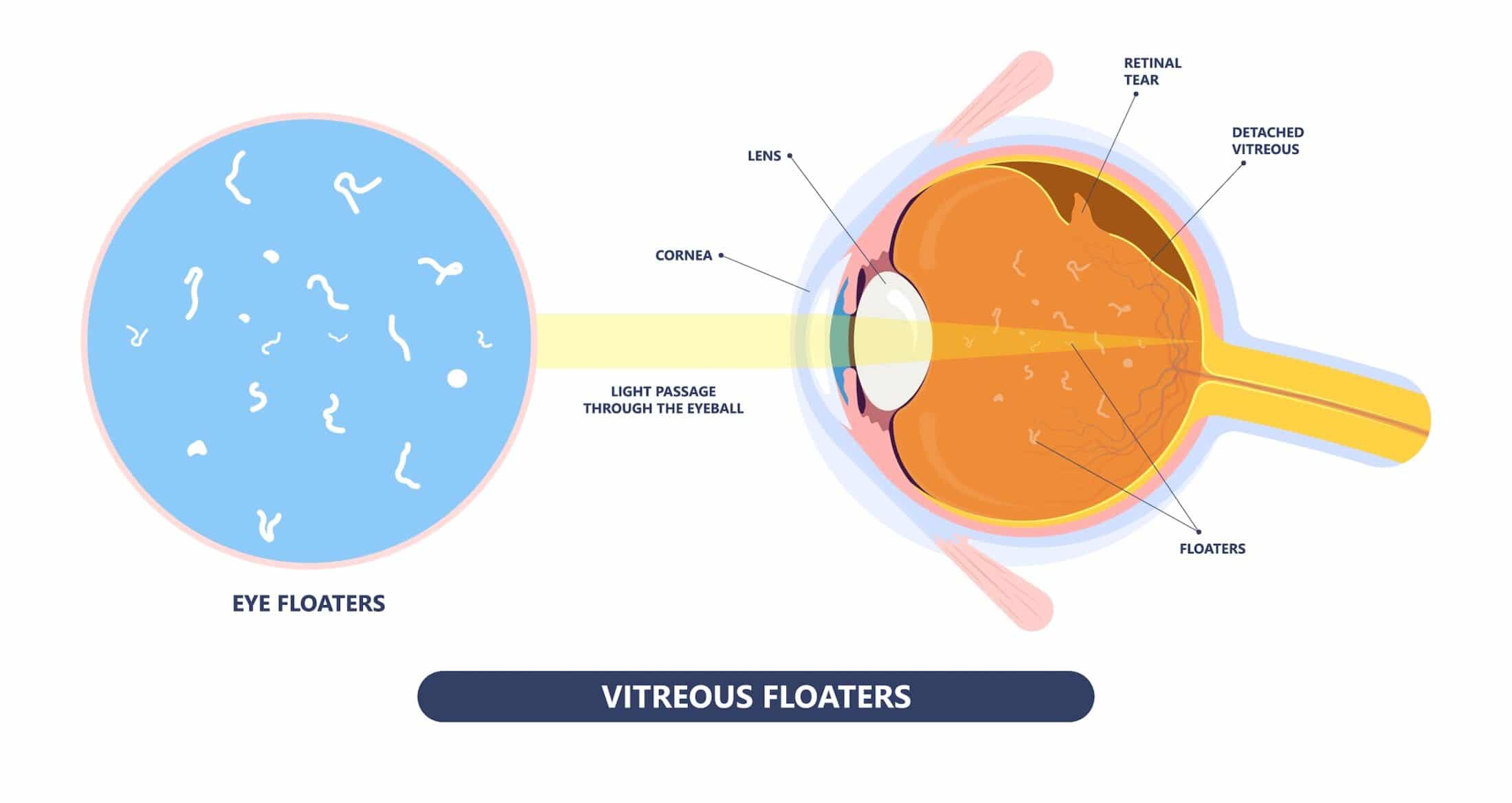 Flashes and Floaters - Alaska Retinal Consultants
