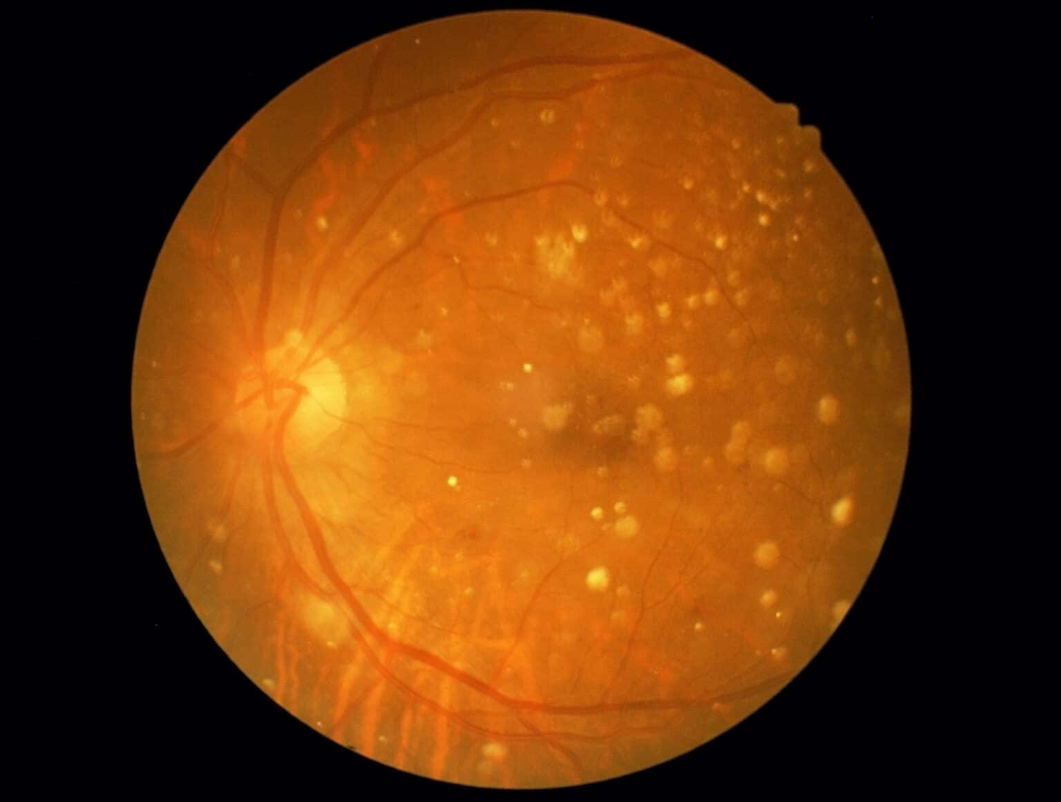 Macular Degeneration - Alaska Retinal Consultants